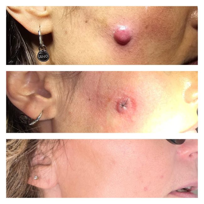 Cisti sebacea senza cicatrici- Leggi il Blog del Dott. Caprara | CdE