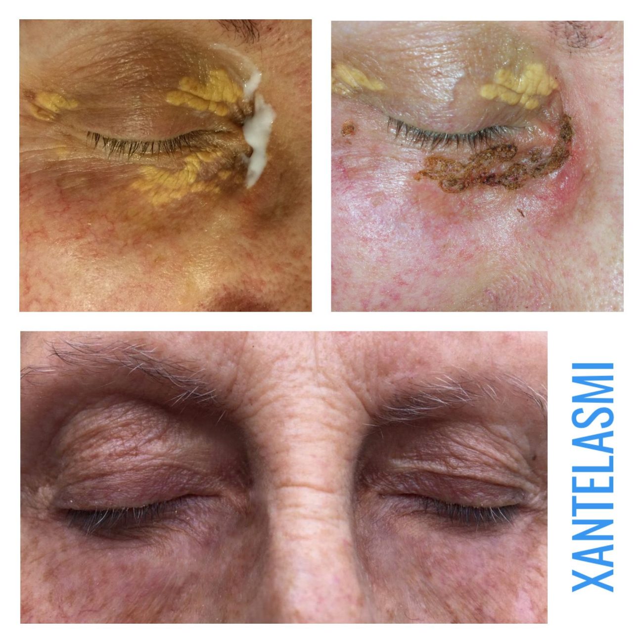 Rimozione degli Xantelasmi senza dolore | Clinica Dermo Estetica | MIlano